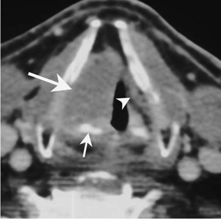 Squamous Cell Carcinoma of the Palatine (Faucial) Tonsil | Radiology Key