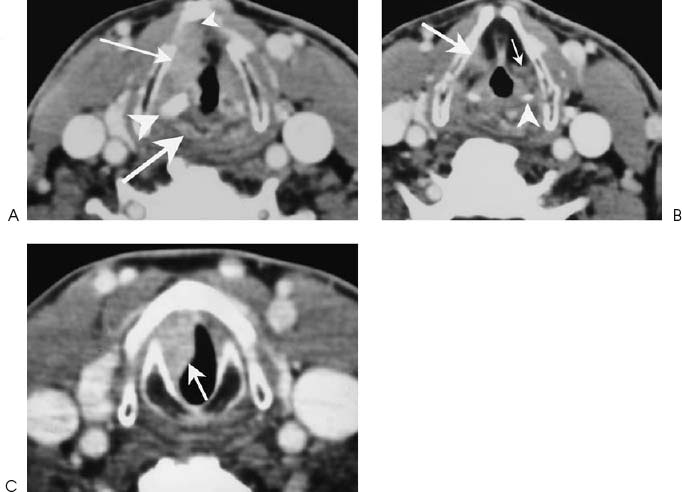 Squamous Cell Carcinoma of the True Vocal Cord (Glottis) | Radiology Key