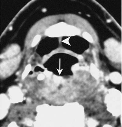 Squamous Cell Carcinoma of the Posterior Pharyngeal Wall | Radiology Key