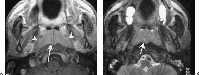 Cervical Lymph Nodes