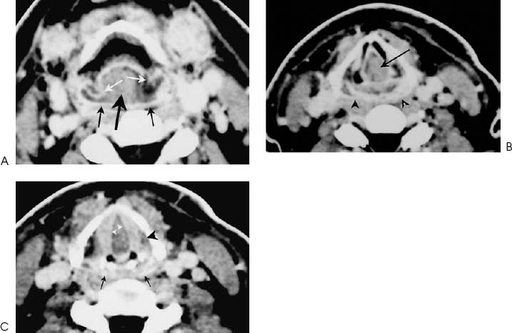 Laryngeal Infection: Supraglottitis | Radiology Key