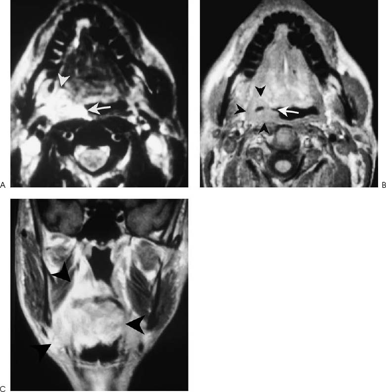 Herpes Pharyngitis | Radiology Key