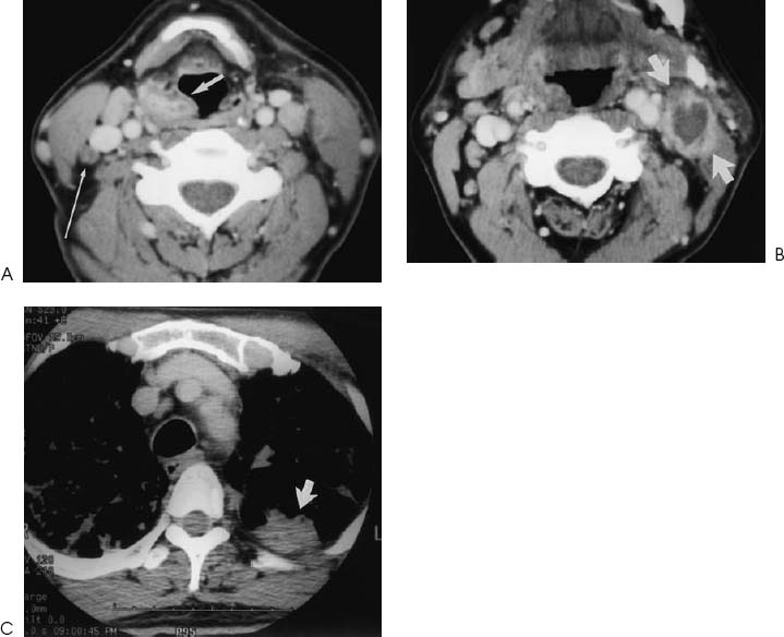 Laryngeal Tuberculosis | Radiology Key