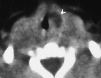 Laryngeal Cysts | Radiology Key