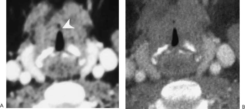 Laryngeal Webs | Radiology Key