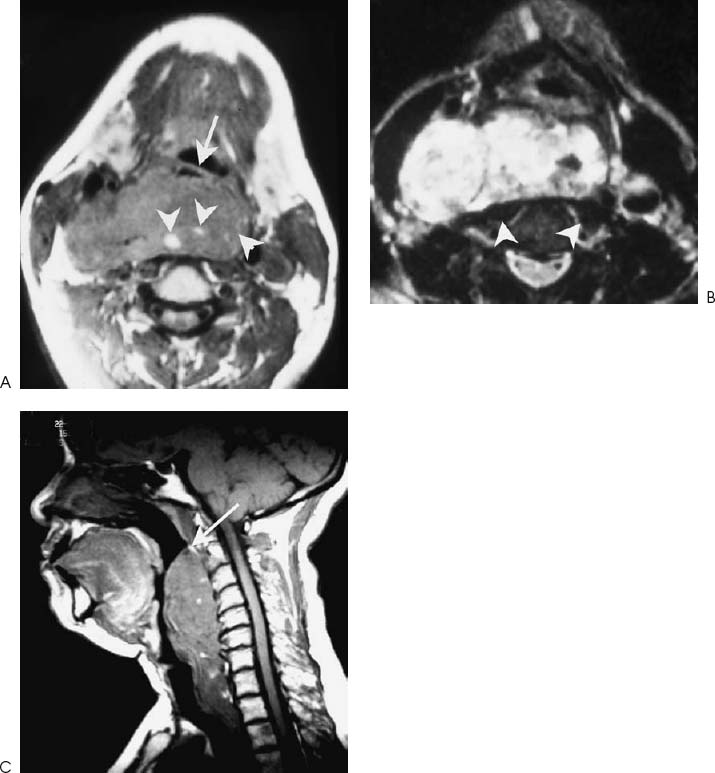 Goiter | Radiology Key