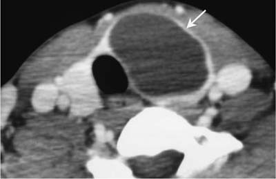 Thyroid Cyst | Radiology Key