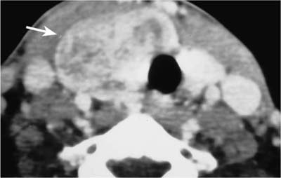 Follicular Thyroid Carcinoma | Radiology Key