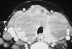 Hashimoto’s Thyroiditis | Radiology Key