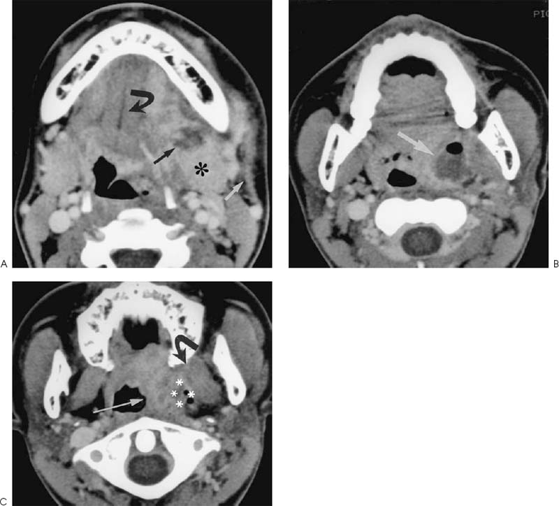 Infection | Radiology Key