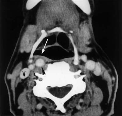 Normal Variants That May Mimic Disease | Radiology Key