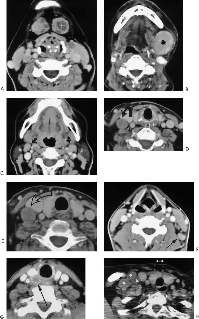 Metastatic Cervical Lymphadenopathy | Radiology Key