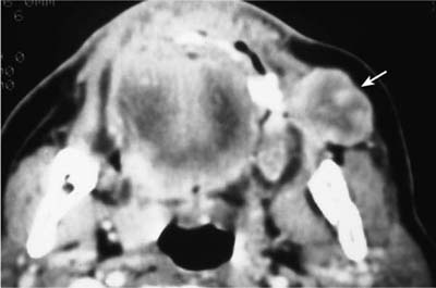 Lymph Nodes | Radiology Key