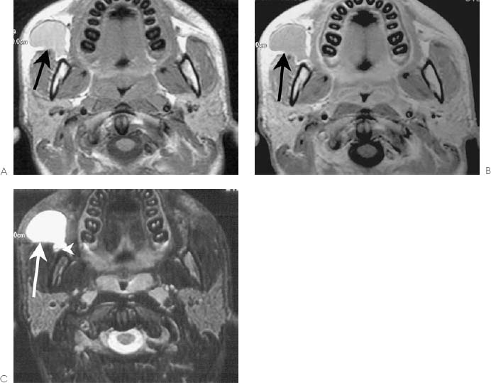 Lymphatic Malformations | Radiology Key