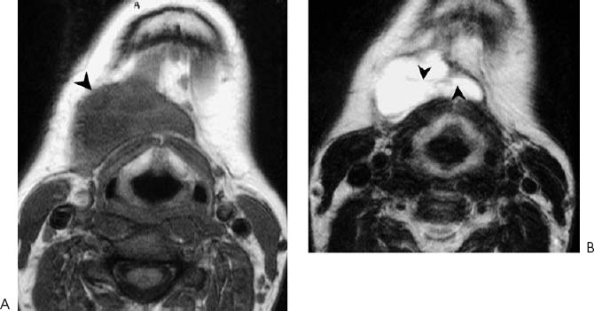Lymphatic Malformations | Radiology Key