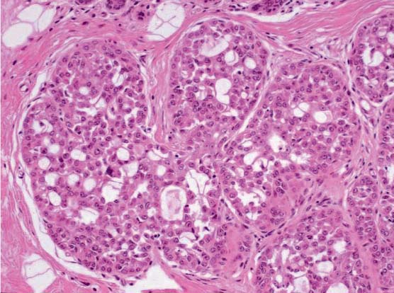 Histologic Evaluation of Core Needle Biopsy Specimens | Radiology Key