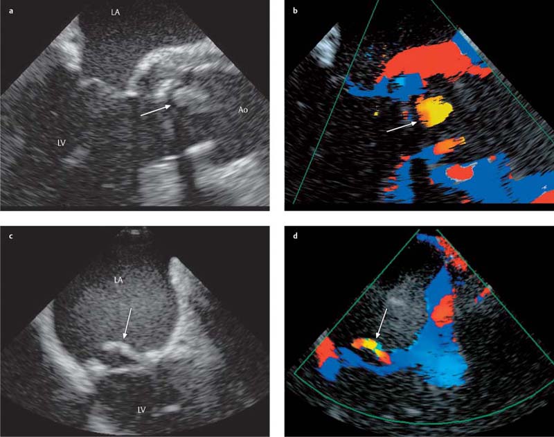 Heart Defects and Endocarditis | Radiology Key