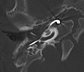 Pathology of the Temporal Bone | Radiology Key