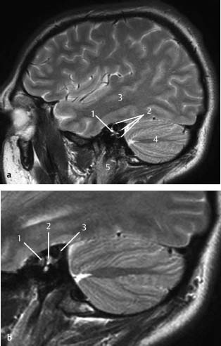 Radiologic Anatomy of the Skull Base | Radiology Key