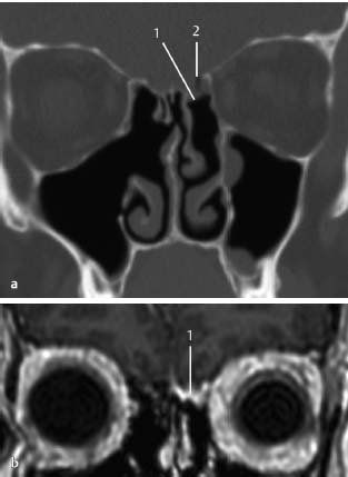 Pathology of the Skull Base | Radiology Key