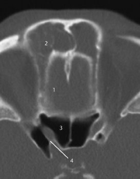Radiologic Anatomy of the Nasal Cavity and Paranasal Sinuses ...