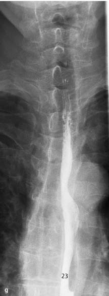 Radiologic Anatomy of the Neck | Radiology Key