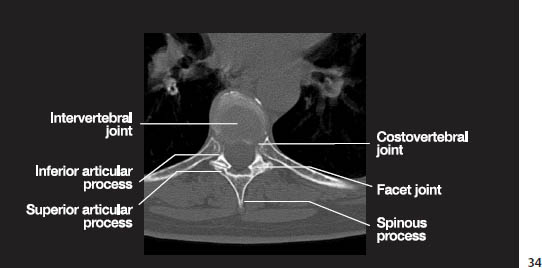 Tomography of the Spine | Radiology Key