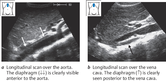 Stomach, Duodenum, and Diaphragm | Radiology Key