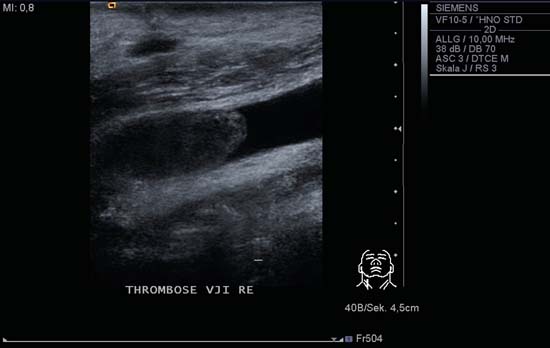 Extracranial vessels | Radiology Key