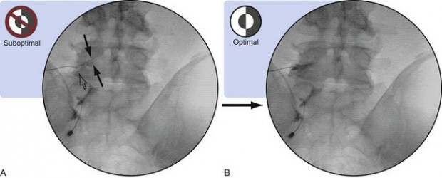 Fluoroscopic Techniques/Procedural Pearls | Radiology Key