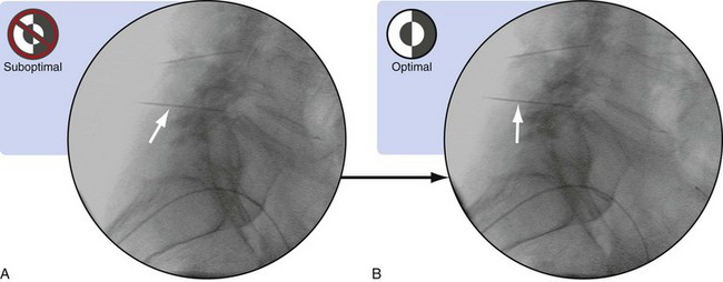 Lumbar Zygapophysial Joint Nerve (Medial Branch) Radiofrequency ...