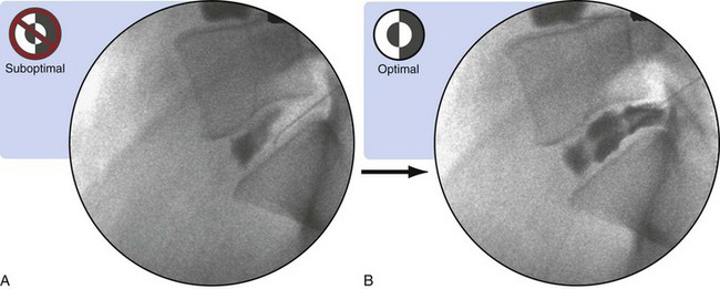 Lumbar Provocation Discography/Disc Access | Radiology Key