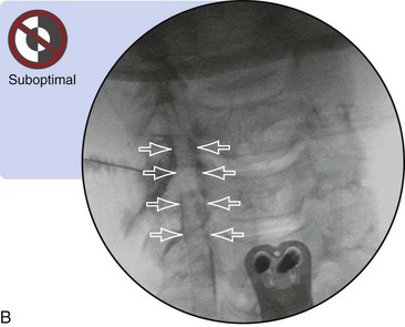 Cervical Transforaminal Epidural Steroid Injection | Radiology Key
