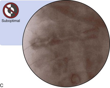 Cervical Zygapophysial Joint Intraarticular Injection, Lateral Approach ...