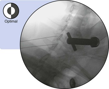 Cervical Zygapophysial Joint Nerve (Medial Branch) Radiofrequency ...