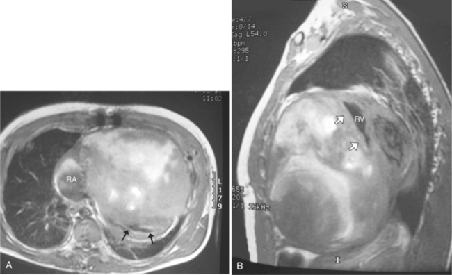 Cardiac Magnetic Resonance Imaging | Radiology Key