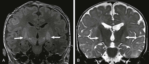 Neonatal Brain Injury | Radiology Key