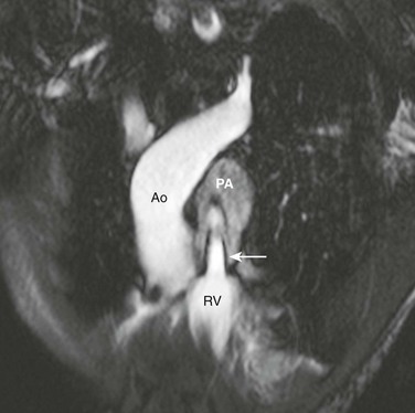 Right Heart Lesions | Radiology Key