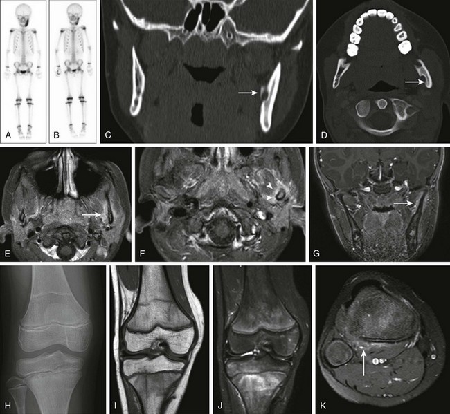 Arthritis and Differential Inflammatory Joint Disorders | Radiology Key