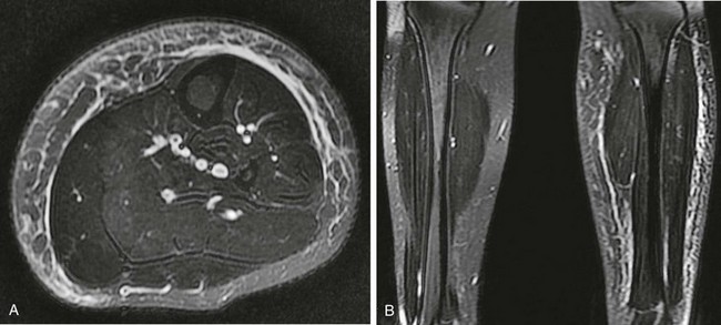Musculoskeletal Infections | Radiology Key