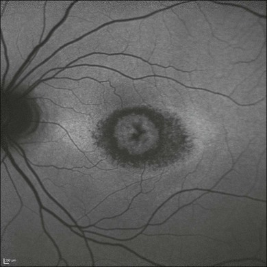 Autofluorescence Imaging | Radiology Key