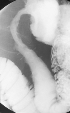 Introduction to inflammatory conditions of the small and large bowel ...