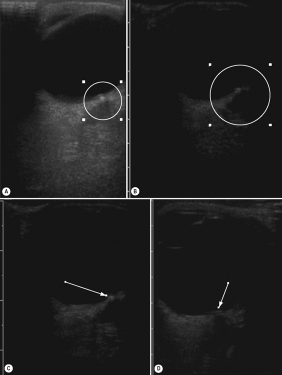 The child’s eye | Radiology Key