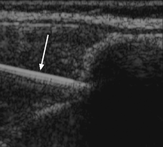 Pediatric interventional ultrasound | Radiology Key