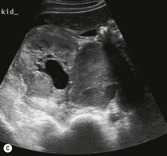 Ultrasound of the retroperitoneum and gastrointestinal tract ...