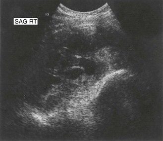 Ultrasound of the acute abdomen | Radiology Key