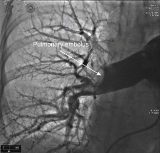 Angiography | Radiology Key