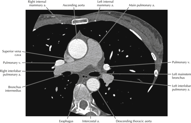 Cardiac Anatomy Using CT Radiology Key Cardiac Anatomy Using CT Radiology Key