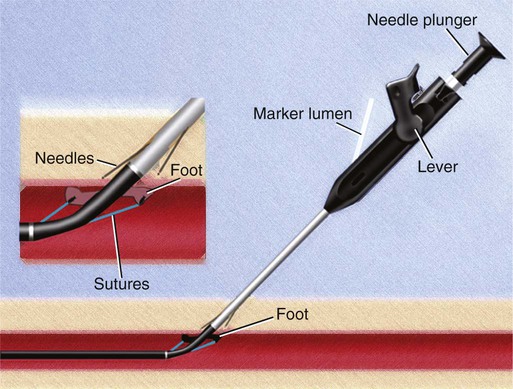 Principles of Arterial Access | Radiology Key