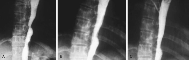 Management of Vascular Arteritides | Radiology Key